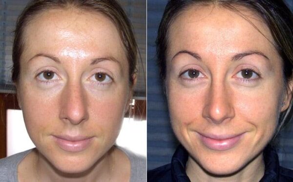 Setto nasale deviato: sintomi, rimedi naturali e operazione