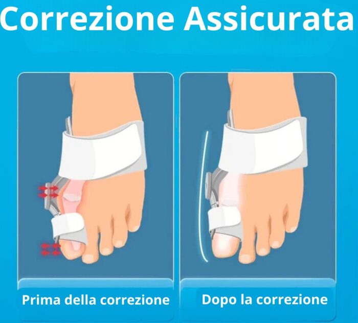 Miglior tutore per alluce valgo: recensioni vere